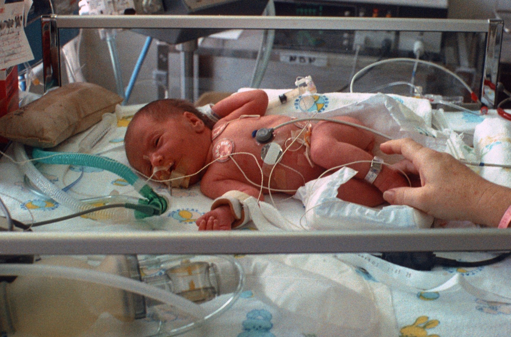Neonatal Suction Catheter Complications